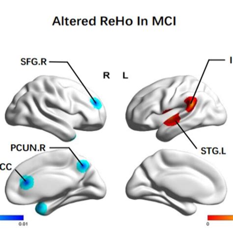 figure brain regions showing altered alff falff values in patients with