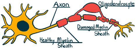 Does The Myelin Sheath Play A Role In MS