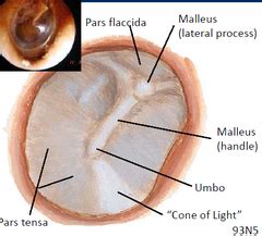 Pars Tensamajority Tympanic Membrane 55 Mm Squared In Area Medical