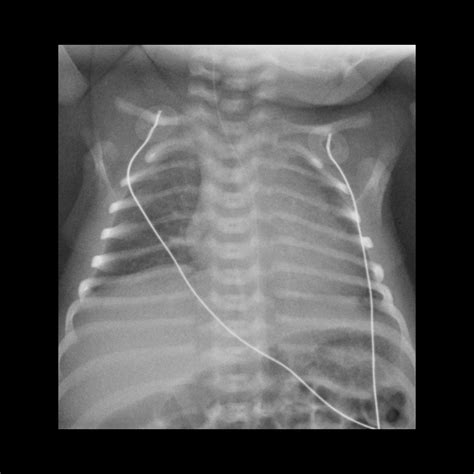 Premature Newborn After Scalp PICC Placement Pediatric Radiology Case Pediatric Imaging