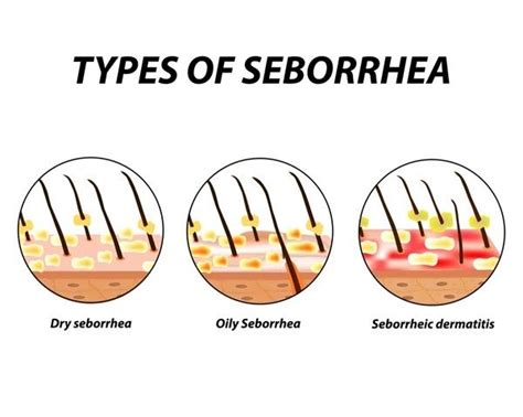 সেবোরিক ডার্মাটাইটিস Seborrheic Dermatitis ও এর ঘরোয়া প্রতিকার Nobonirman Patrika