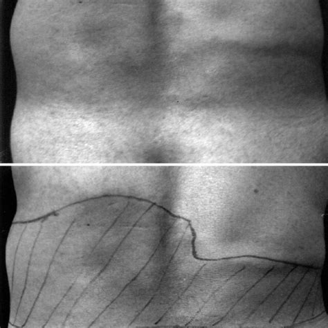 Figure A Well Defined Striking Patch With Compensatory Hyperhidrosis Download Scientific