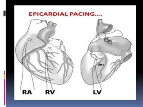Pacemaker Powerpoint Presentation Med Surg Pptx