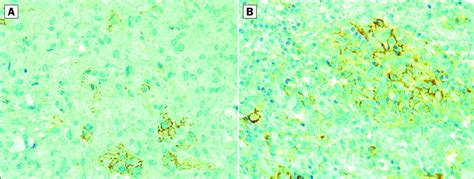 Positive Immunohistochemical Staining For Pd L1 In Gist 40x A Download Scientific Diagram
