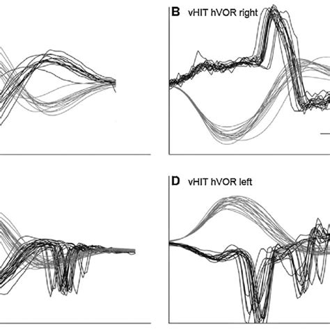 Schematic Occurrence Of Refixation And Physiological Saccades 1 Eye Download Scientific