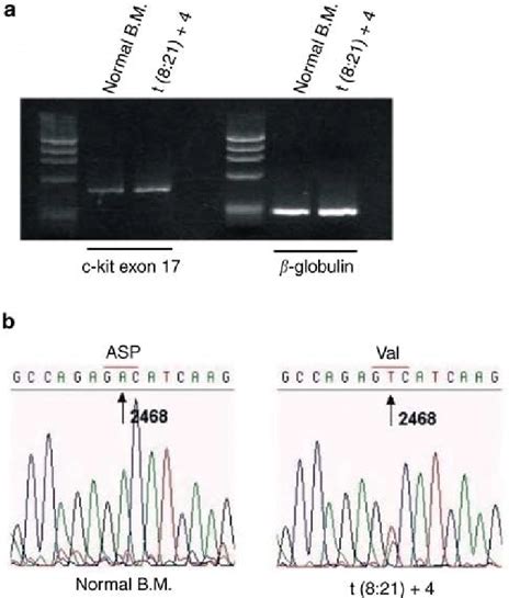 Detection Of C Kit Mutation In Exon 17 In A T821 Aml With Trisomy 4