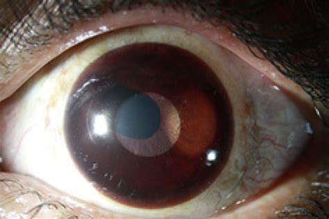 Monocular Diplopia An Optical Correction Modality Pmc