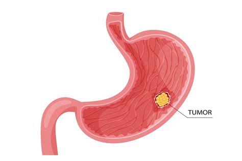 Gist Dạ Dày Khối U Mô đệm đường Tiêu Hóa Và Những điều Nên Biết