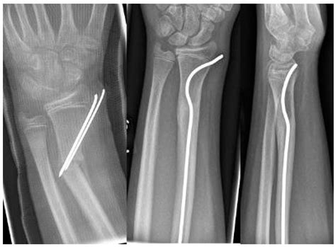 Intramedullary Pin Fracture Fixation At Ruben Lefebvre Blog
