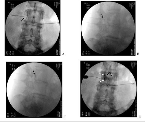 Difference Between Subdural And Epidural