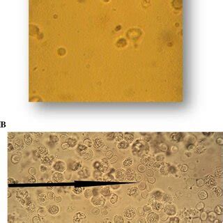Red Blood Cell Morphology In The Urine A Acanthocytes Irregular Download Scientific Diagram