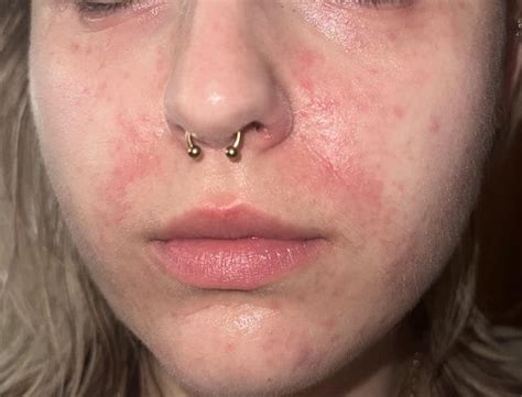 Rosacea Diagnosed Is This Normal To Have This Sort Of Progression