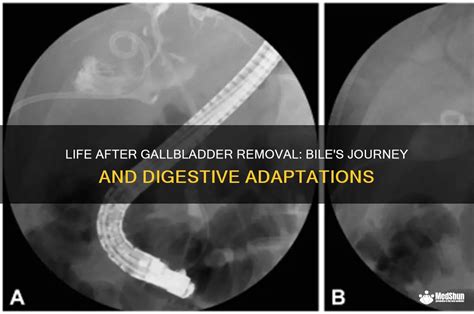 Life After Gallbladder Removal Biles Journey And Digestive Adaptations Medshun