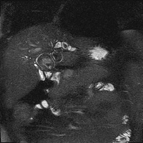 Intraoperative View Of Hepaticojejunostomy To Be Revised Download