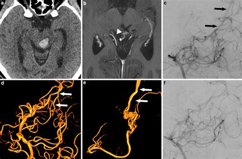 Glue Embolization Complications At Becky Moreno Blog