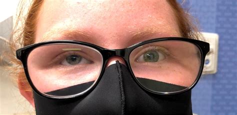 Dissociated Vertical Deviation American Association For Pediatric