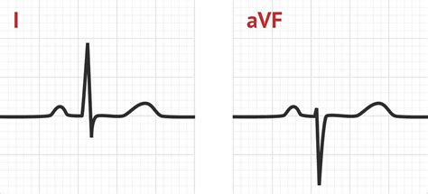 Left Anterior Fascicular Block Conduction Disorders Medschool