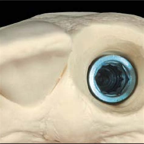 A Case Of Craniofacial Cleft Where Unilateral Box Osteotomy Was