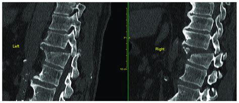 Preoperative Ct Scan Showing A Bilateral Locked Facet Download