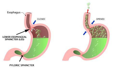 Hypochlorhydria Symptoms Causes And Tips Nutrition By Erin