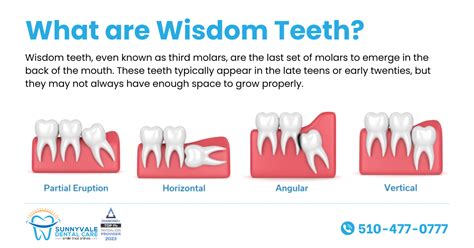 Wisdom Teeth Extraction Removal Procedure Sunnyvale