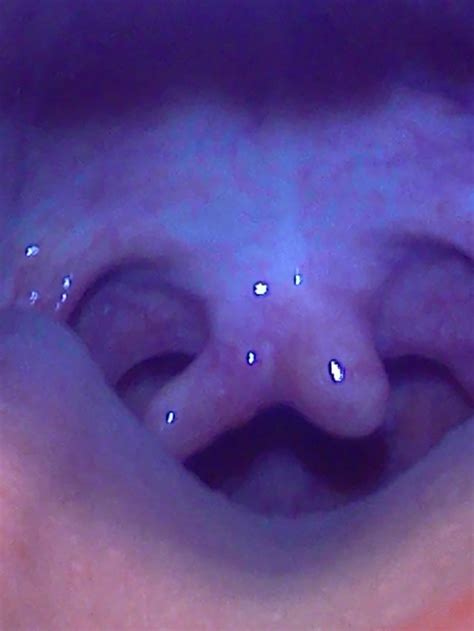 My Bifid Uvula Wtf