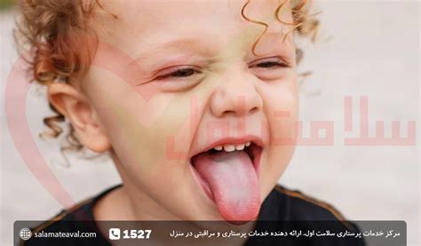 برفک دهان نوزادان علائم و درمان قطعی آن عکس