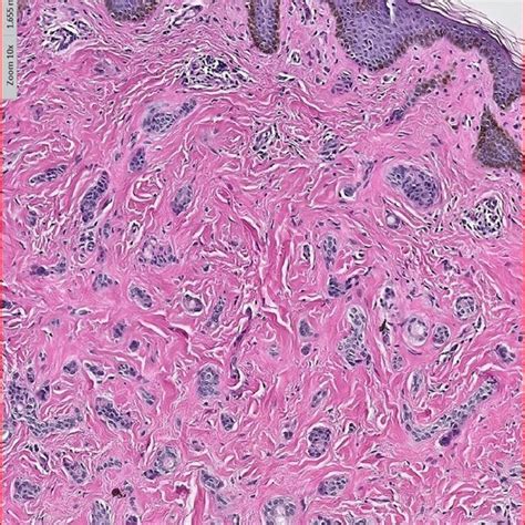 The 2 3 Mm Hyperpigmented Papules Over The Patients Neck And Upper Chest Download Scientific