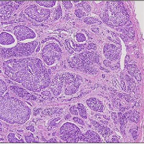 Colonoscopy Finding Shows A Normal Appearing Appendiceal Orifice Except