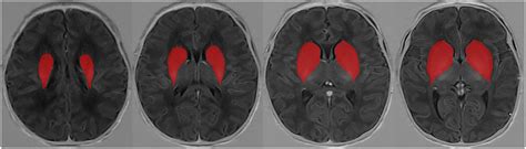 Semi Automatic Segmentation A Region Growing Method Was Used To Sketch Download Scientific