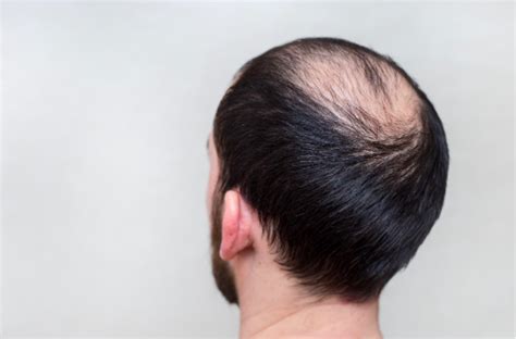 What Are Bald Patches And What Causes Them Posh Lifestyle Beauty Blog