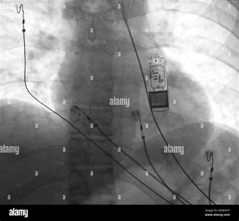 Cardiac Monitor Implant X Ray Of A Section Through The Chest Of A