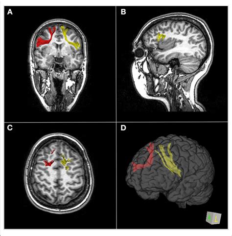 Mr Diffusion Tensor Imaging Of The Frontal Aslant Tract Fat In A Download Scientific