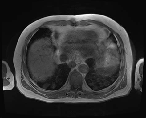 Cholangiocarcinoma Hilar Type Radiopaedia 59780 67206 Axial T1 In Phase Nc Commons