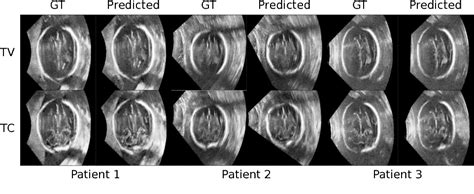 Standard Plane Detection In 3d Fetal Ultrasound Using An Iterative