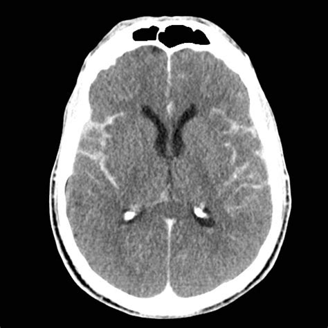 Radiopaedia Case Subarachnoid Hemorrhage Id 42687 Study 45846 Nc