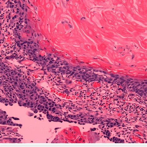Intermediate Power View 100x Showing Basaloid Tumor Cells With Ghost Download Scientific