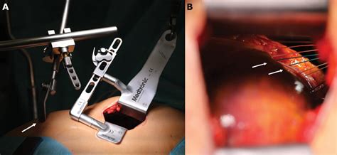 A Surgical Access Via A Left Anterolateral Mini Thoracotomy Using A