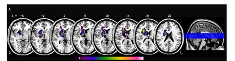 Figure 1 From Dynamic Alterations In Spontaneous Neural Activity In Multiple Brain Networks In