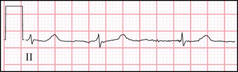 electrocardiograms ekgs ecgs evaluating p waves stepwards