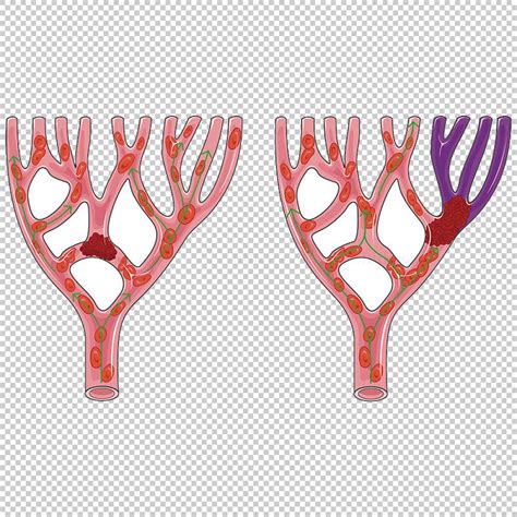 Thrombus Position And Consequences Vector Scientific Illustration