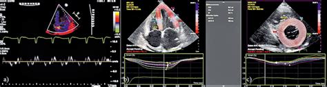 A Tissue Doppler Imaging Evaluation Of The Lv Lateral Wall Showing Download Scientific Diagram