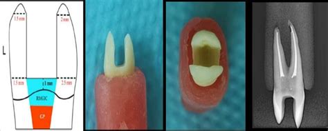 A Photograph Showing Mod Cavity Of A Maxillary 1s Premolar Download