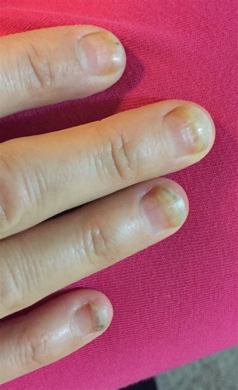 Addendum To “chemo Nails” Healing Frantic Shanti