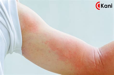 ჭინჭრის ციება ანუ ურტიკარია Kani Clinic • კლინიკა კანი
