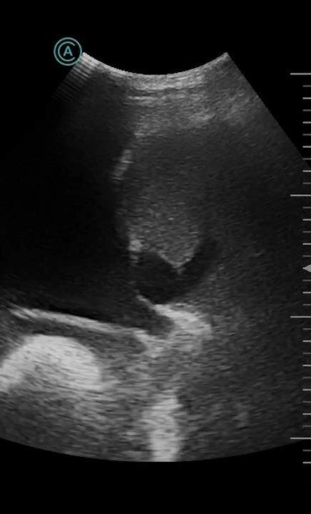 Effusion Case1 Youtube