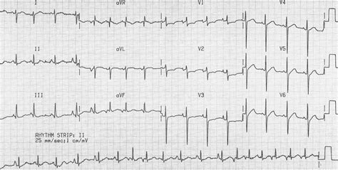 Multifocal Atrial Tachycardia Mat • Litfl • Ecg Library Diagnosis