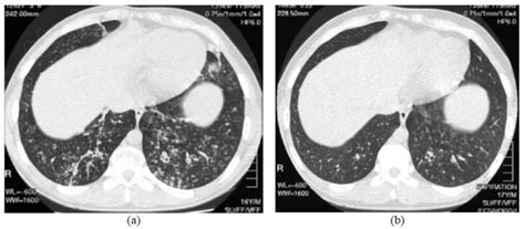 Bronchiectasis Diagnosis And Treatment Medical Library