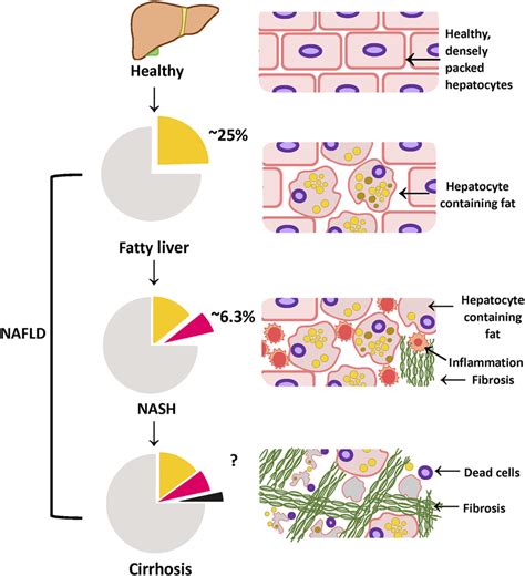 Different Phases Of Nafld Progressing From Healthy To Cirrhosis Nafld