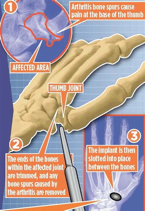 What Is A Thumb Joint Replacement At Noah Stretch Blog